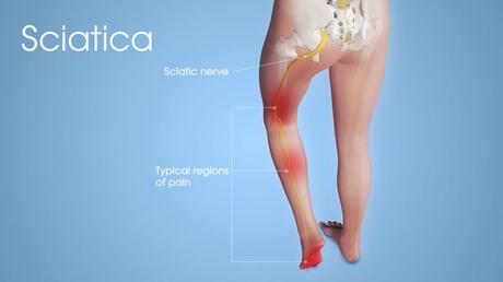 Sciatica, Causes, Signs and Symptoms, Diagnosis and Treatment - Paperblog