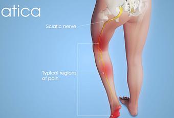 Sciatica, Causes, Signs and Symptoms, Diagnosis and Treatment - Paperblog